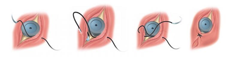 Dental Suture Techniques and Materials in Oral Surgery - Boz Medical
