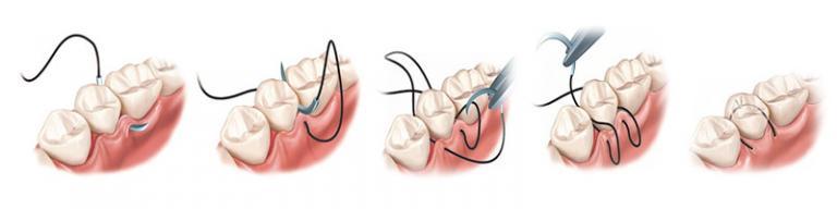 Dental Suture Techniques and Materials in Oral Surgery - Boz Medical