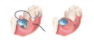 Dental Suture Techniques and Materials in Oral Surgery - Boz Medical