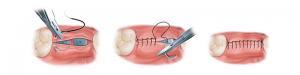 Dental Suture Techniques and Materials in Oral Surgery - Boz Medical