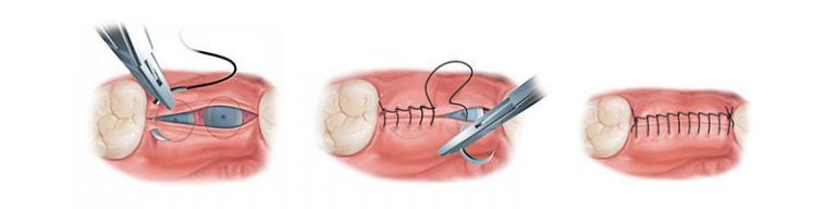 Dental Suture Techniques and Materials in Oral Surgery - Boz Medical