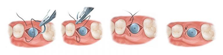 Dental Suture Techniques and Materials in Oral Surgery - Boz Medical