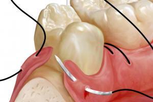Dental Suture Techniques and Materials in Oral Surgery - Boz Medical