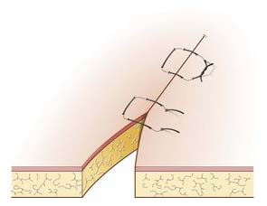 Suture Techniques Used in Veterinary Surgery - Boz Medical