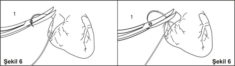Usage Techniques for Temporary Pace Wire - Boz Medical
